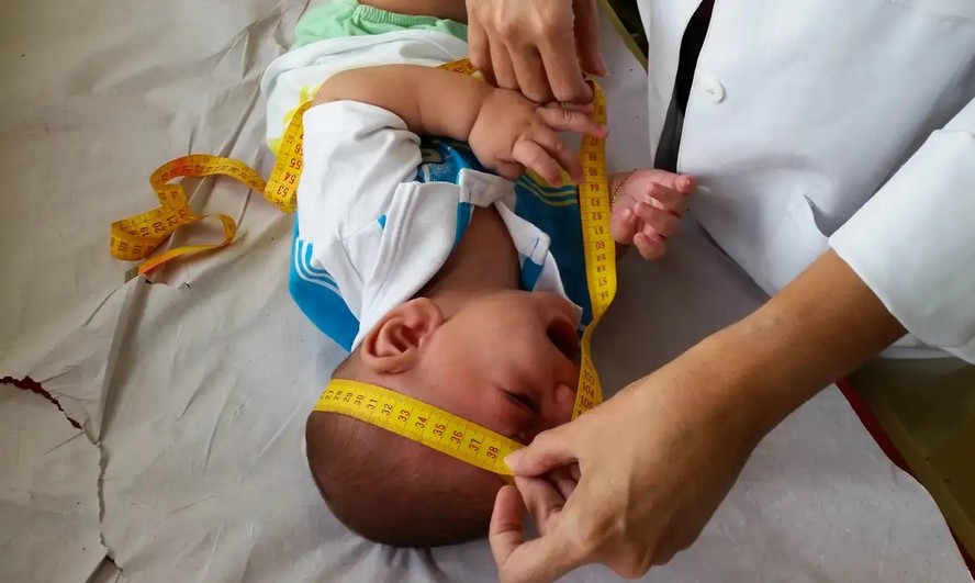 Mais de 20% das crianças com microcefalia por zika vírus desenvolveram ...