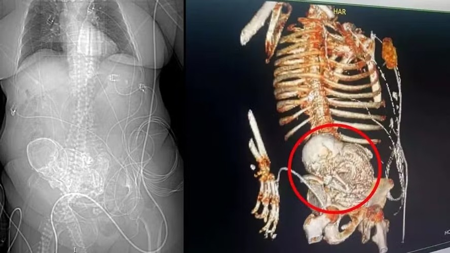 'Bebê de pedra': aos 81, mulher descobre carregar feto calcificado por ...