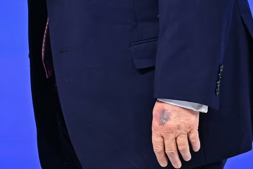 Trump explica hematoma em mão como batida em mesa e alta dose de aspirina
